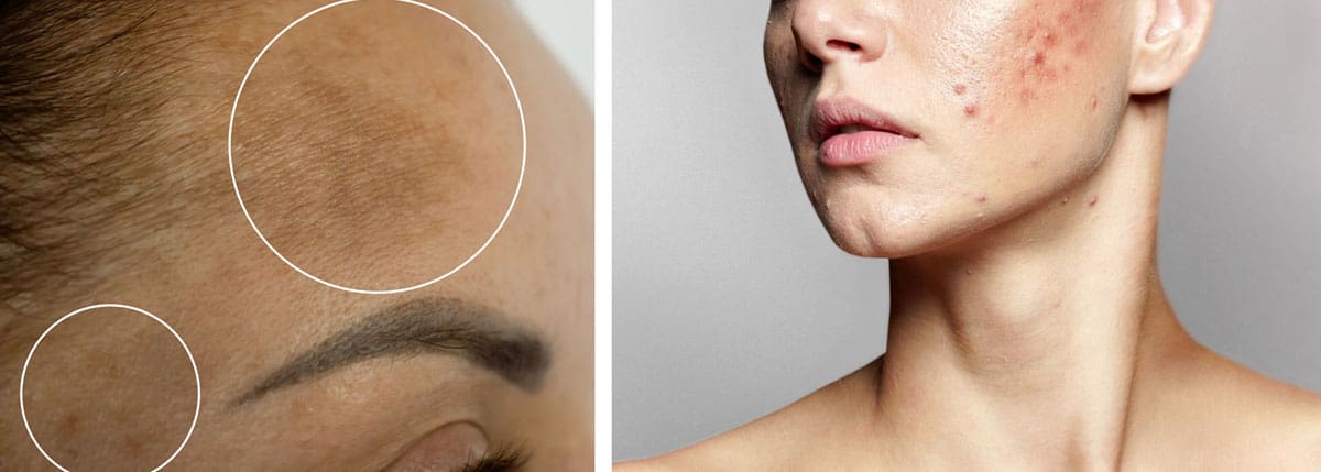 Fruchtsäurepeeling – Hautarztpraxis Michaela Schirutschke